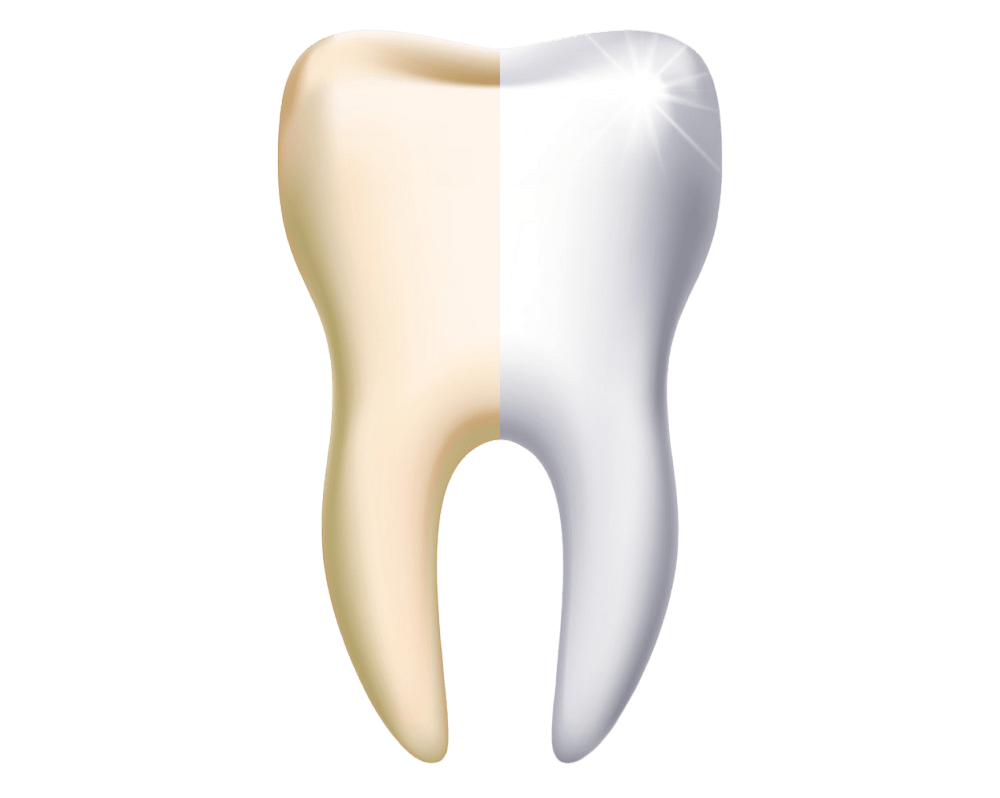 Instant Teeth Whitening in Dubai - Sejovi Dental & Implant Center